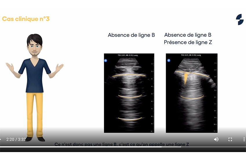 Cas Cliniques Syndrome Interstitiel | Sonoschool