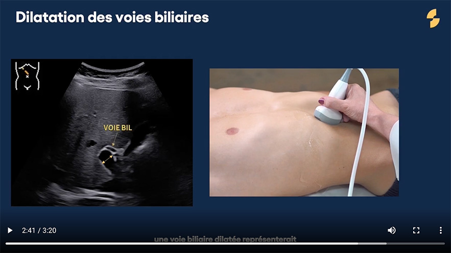 Échographie de la vésicule | Sonoschool