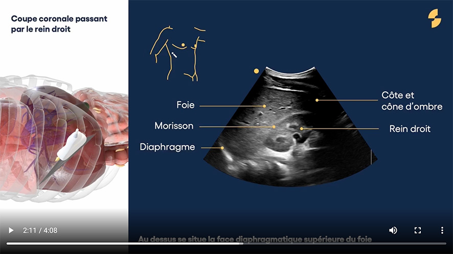 Les 3 coupes sagittales du foie - Sonoschool
