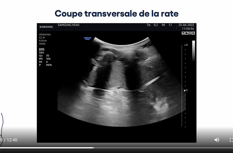 Écho-anatomie de la rate | Sonoschool