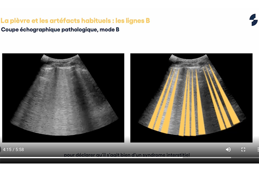 Échographie syndrome interstitiel | Sonoschool
