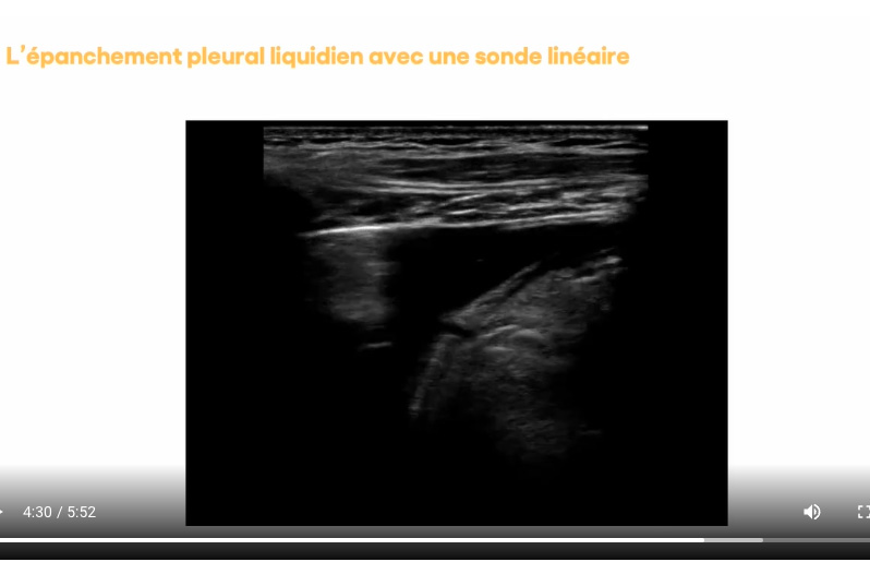 Échographie Épanchement Pleural | Anatomie et Écho-anatomie