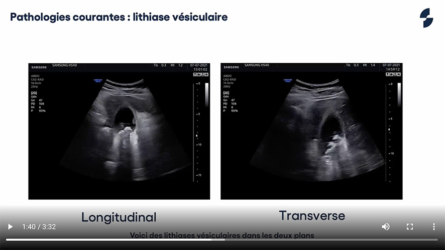 Pathologies vésiculaires en échographie | Sonoschool