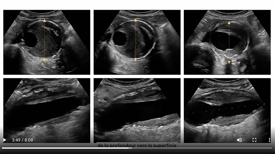 Pathologies Aortiques en Échographie | Sonoschool