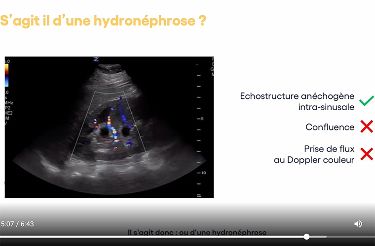 Formation échographie | Colique Néphrétique | Sonoschool