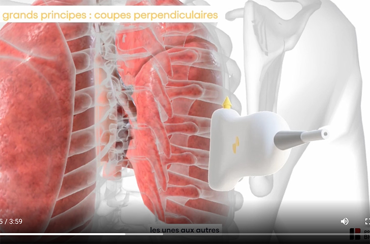 Principes de l'échographie pulmonaire | Sonoschool