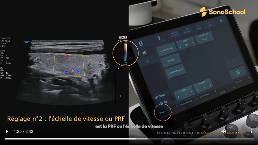 Échographie Doppler Couleur | Réglages de base - Sonoschool