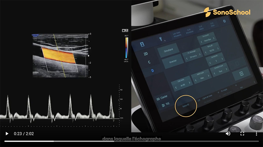 Échographie Doppler Pulsé : Les réglages fondamentaux