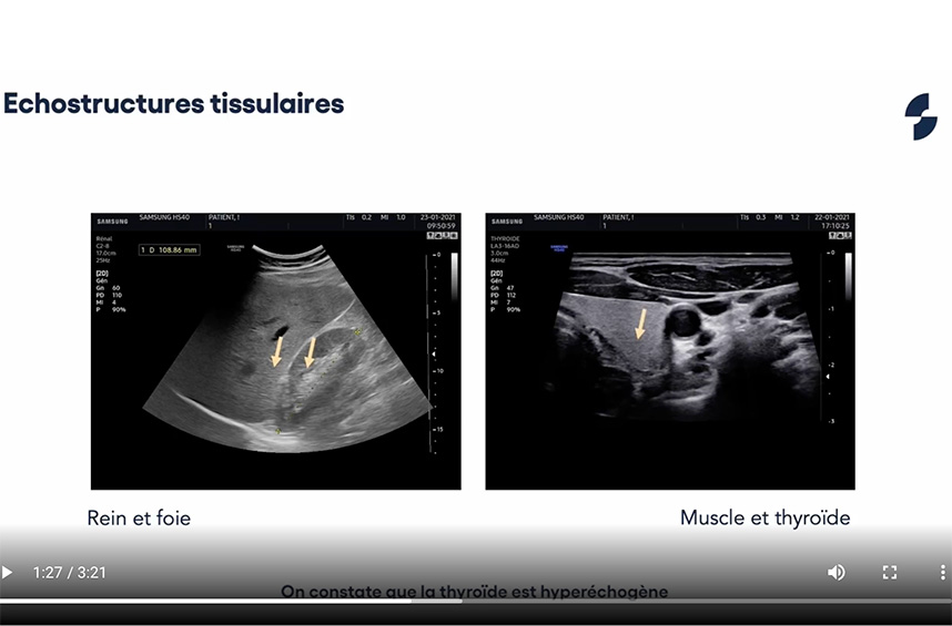 L'échostructure en échographie | Sonoschool