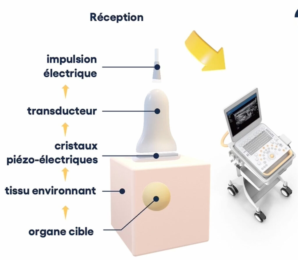 Sonde d'échographie : ce qu'il faut savoir | iSonic Samsung
