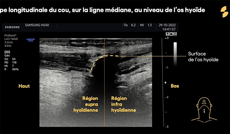 Anatomie du cou pour l'examen de la thyroide