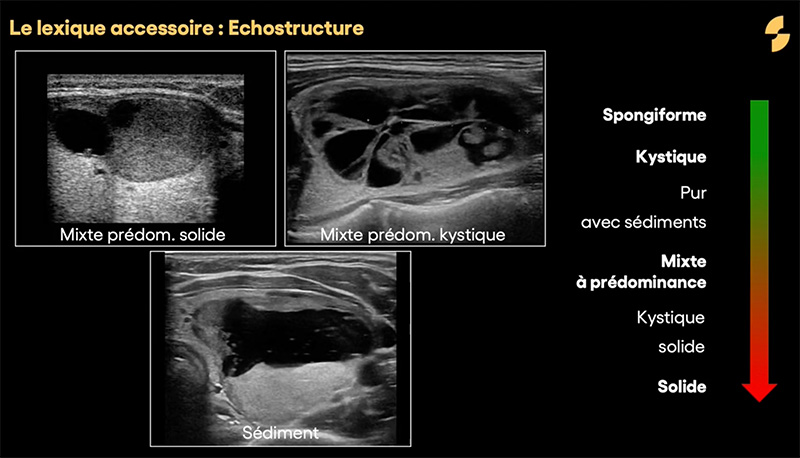 Classification EU TIRADS en Echographie | Sonoschool