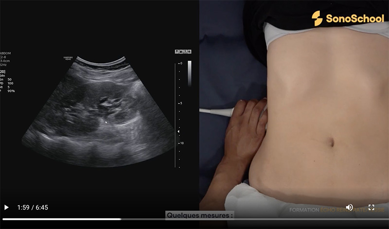 Formation échographie de la vessie | Sonoschool