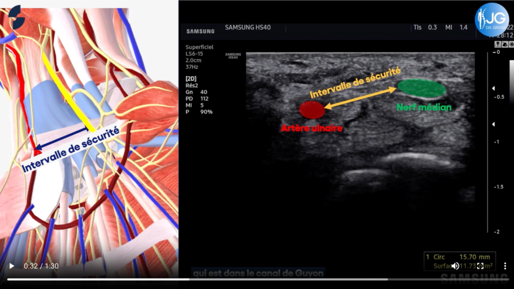 Échographie & infiltration canal carpien : les étapes