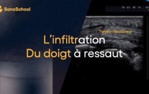 Infiltration sous échographie | Sonoschool x Jimmy Gross