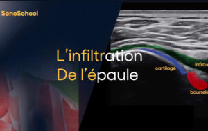Infiltration sous échographie | Sonoschool x Jimmy Gross
