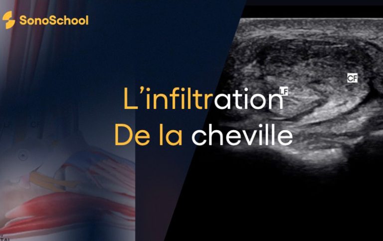 Infiltration sous échographie | Sonoschool x Jimmy Gross