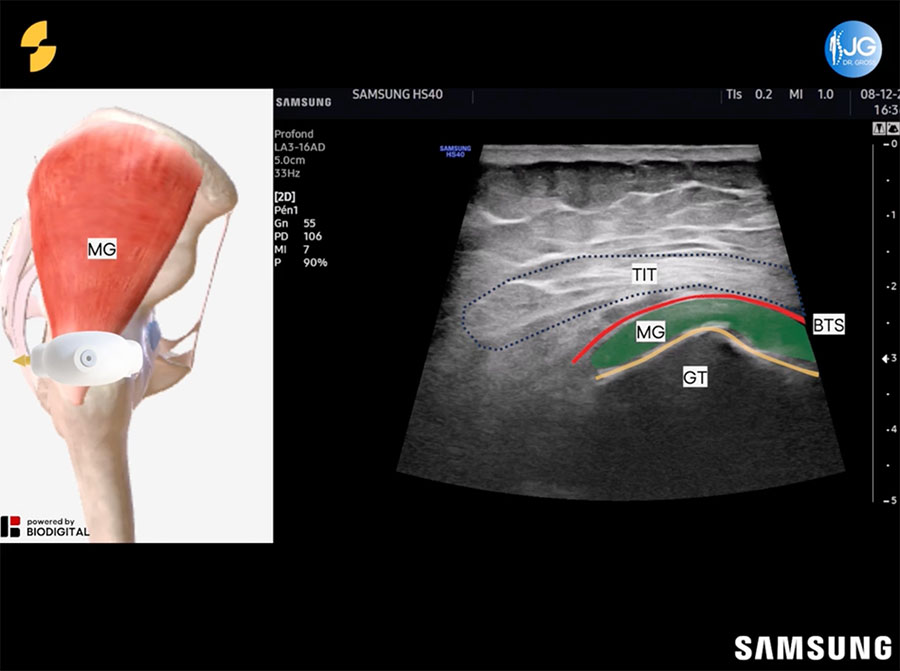 Infiltration de la Hanche sous Echographie | Sonoschool