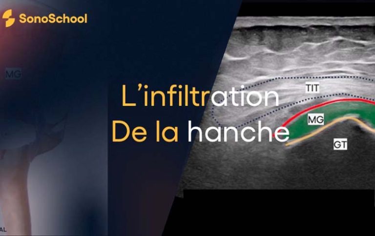 Infiltration sous échographie | Sonoschool x Jimmy Gross