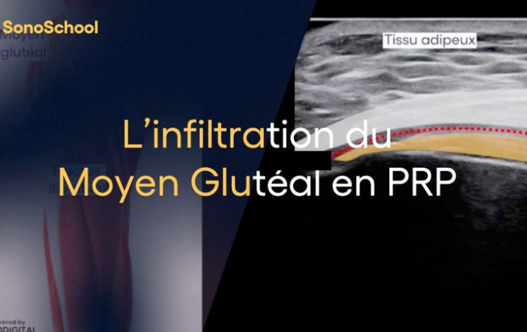 Infiltration sous échographie | Sonoschool x Jimmy Gross