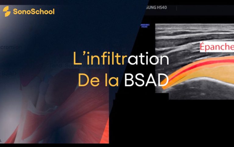 Infiltration sous échographie | Sonoschool x Jimmy Gross