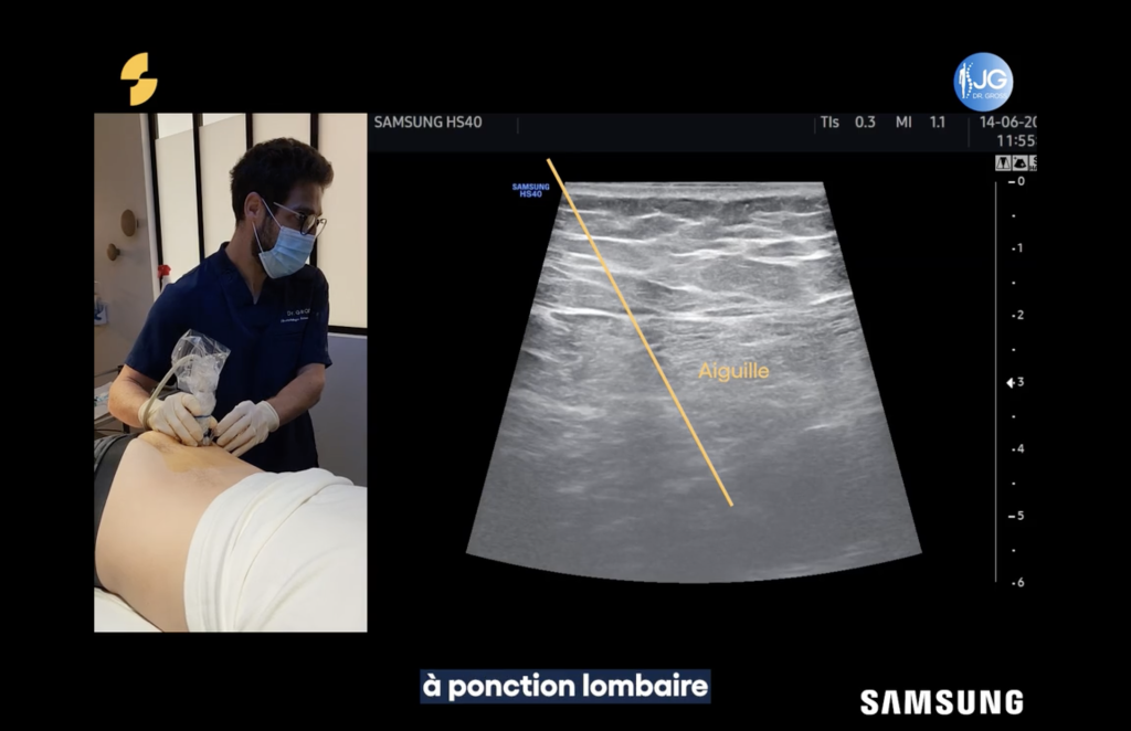 Infiltration du Piriforme Sous Echographie | Sonoschool
