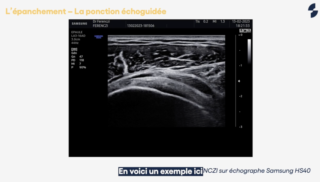 Pathologies De l'Épaule en Échographie | Sonoschool